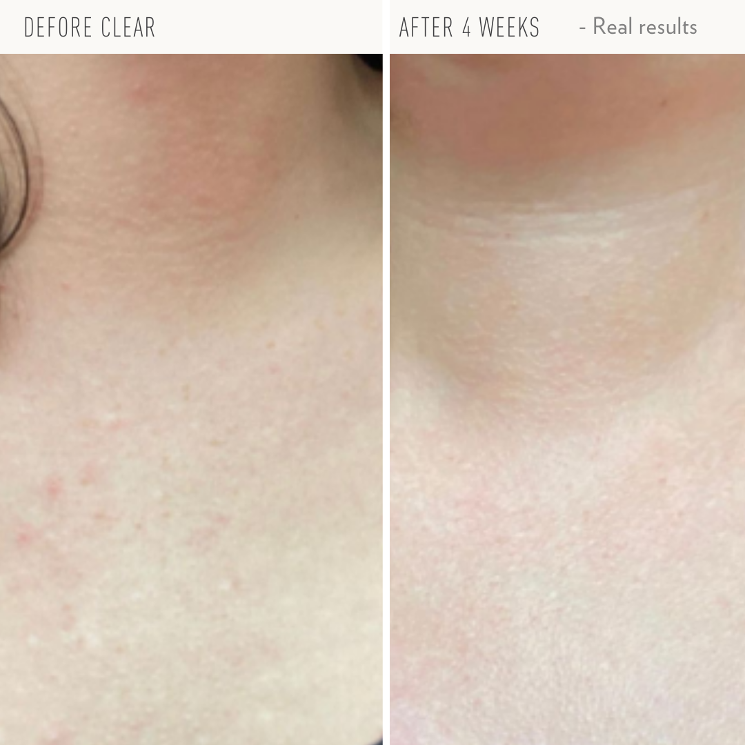 ACNE AND SEBUM CONTROL - PACK